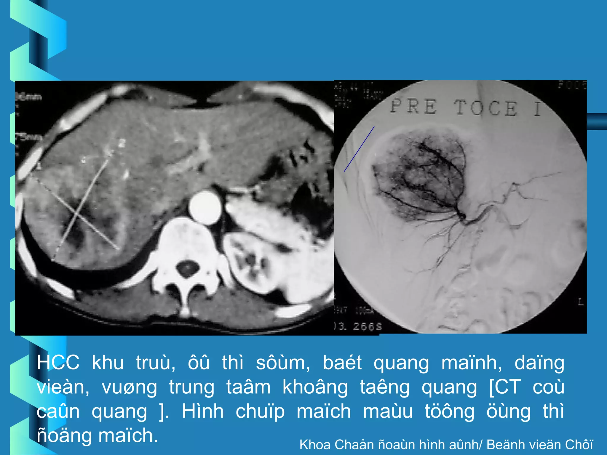 Ct giai phau bung & u gan | PPT