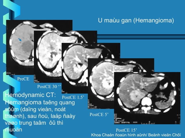 Ct giai phau bung & u gan | PPT