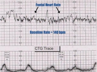 CTG: Interpretation and management | PDF