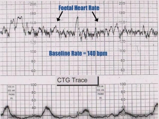 CTG: Interpretation and management | PDF | Pregnancy | Reproductive Health