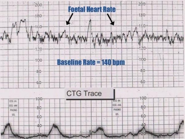CTG: Interpretation and management