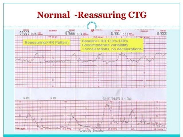CTG: Interpretation and management
