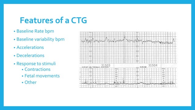 CTG Interpretation .pptx