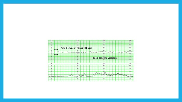 CTG Interpretation .pptx