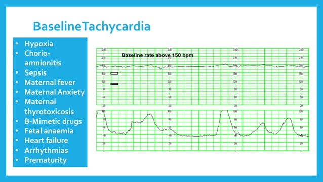 CTG Interpretation .pptx
