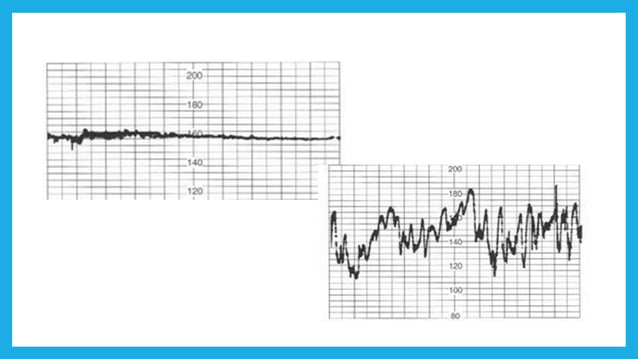 CTG Interpretation .pptx