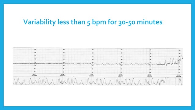 CTG Interpretation .pptx