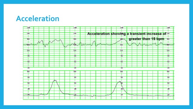 CTG Interpretation .pptx