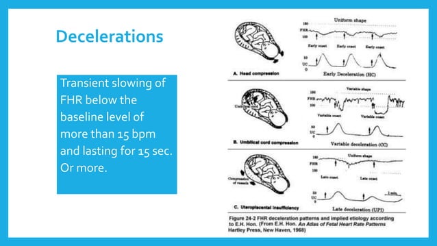 CTG Interpretation .pptx