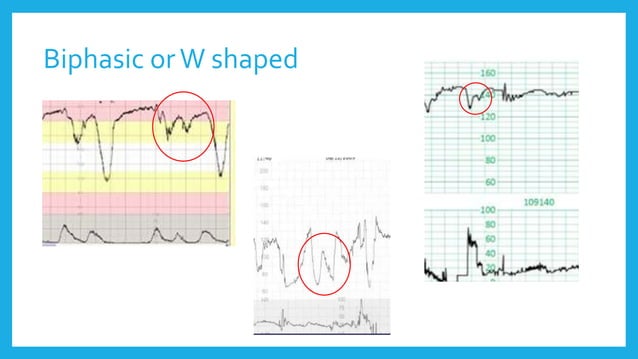 CTG Interpretation .pptx