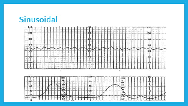 CTG Interpretation .pptx