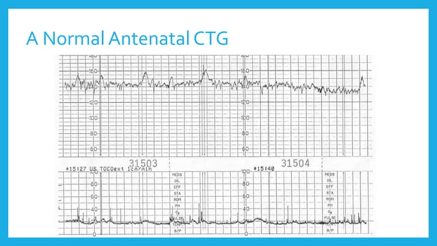 CTG Interpretation .pptx