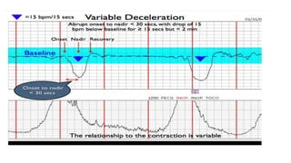 CTG INterpretation.pptx