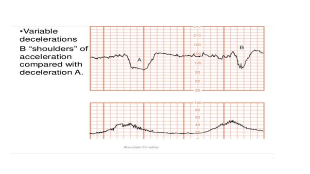 CTG INterpretation.pptx | Pregnancy | Reproductive Health