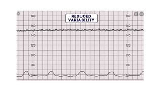 CTG INterpretation.pptx
