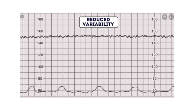 CTG INterpretation.pptx | Pregnancy | Reproductive Health