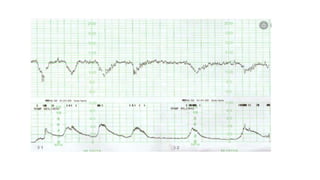 CTG INterpretation.pptx