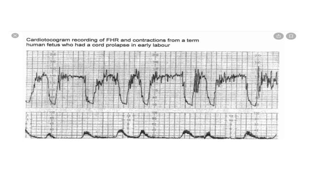CTG INterpretation.pptx | Pregnancy | Reproductive Health