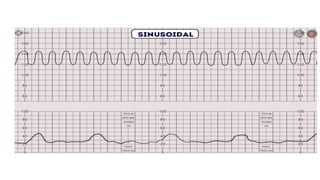 CTG INterpretation.pptx