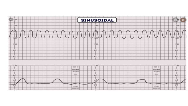CTG INterpretation.pptx | Pregnancy | Reproductive Health