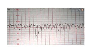 CTG INterpretation.pptx