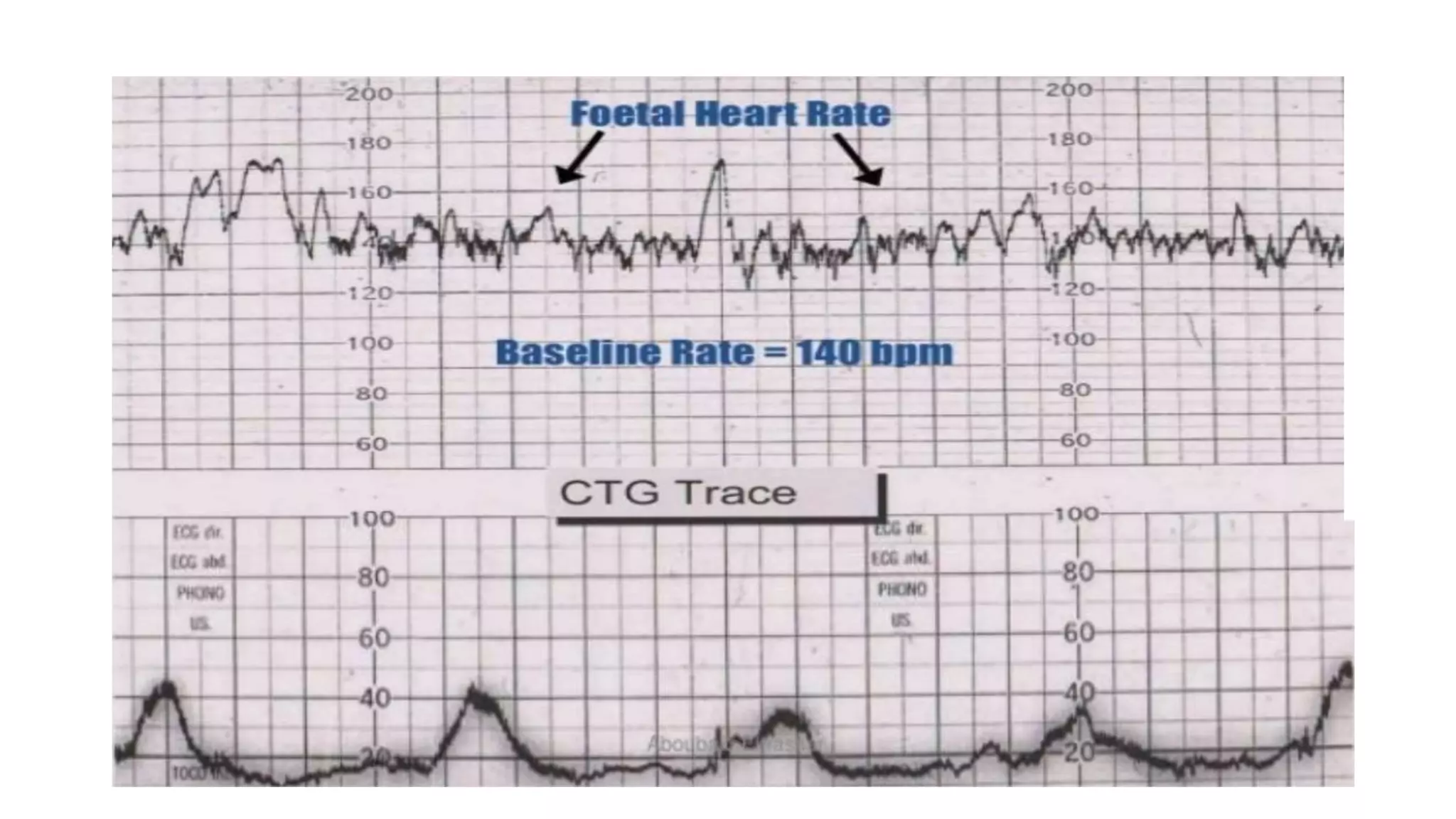 Ctg interpretation and mangment | PPTX