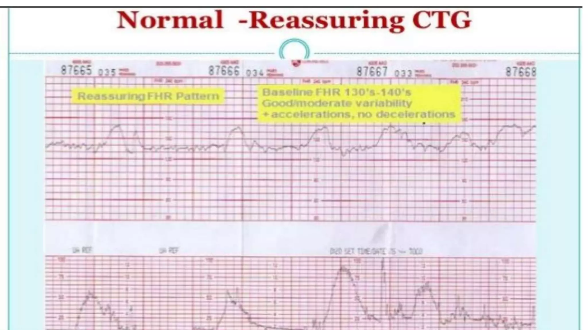 Ctg interpretation and mangment | PPTX