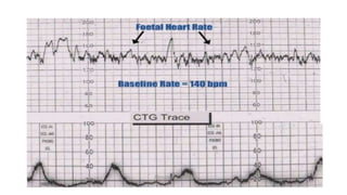 Ctg interpretation and mangment | PPTX