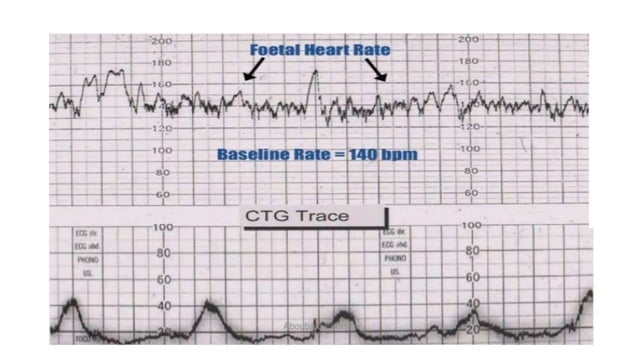 Ctg interpretation and mangment | PPTX | Pregnancy | Reproductive Health