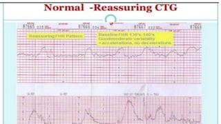 Ctg interpretation and mangment | PPTX