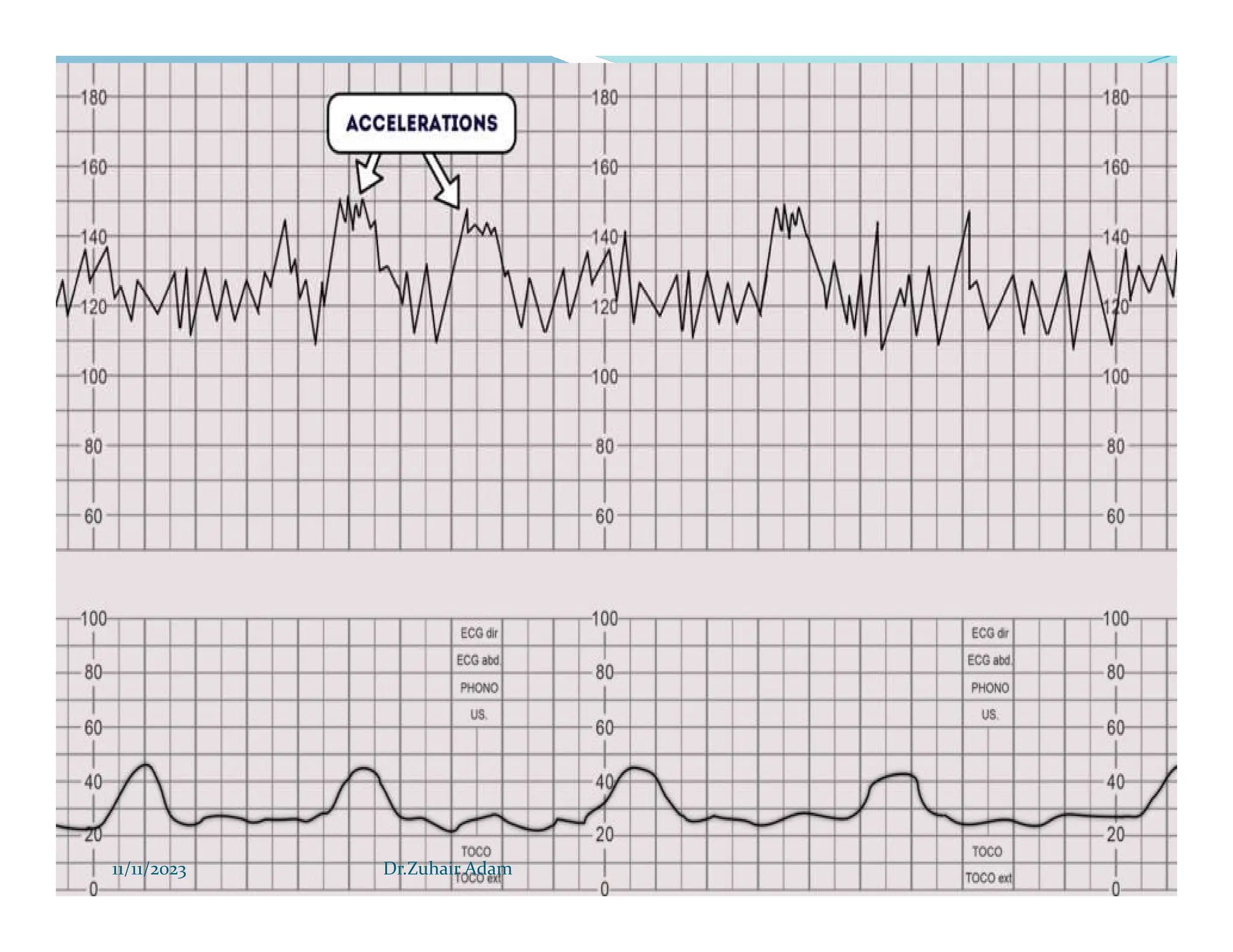 CTG INTERPRETATION Dr zuhair 2023.pdf