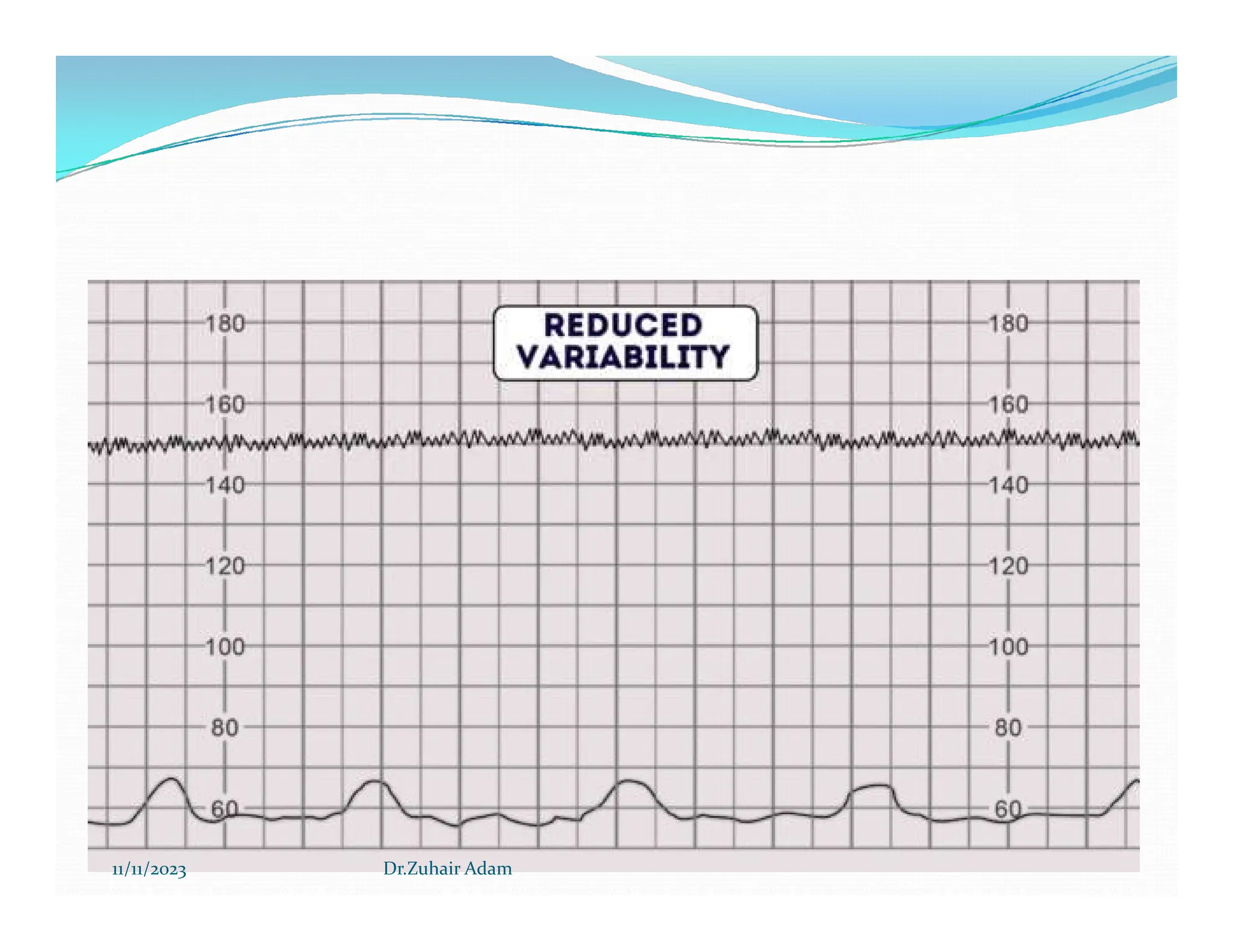 CTG INTERPRETATION Dr zuhair 2023.pdf