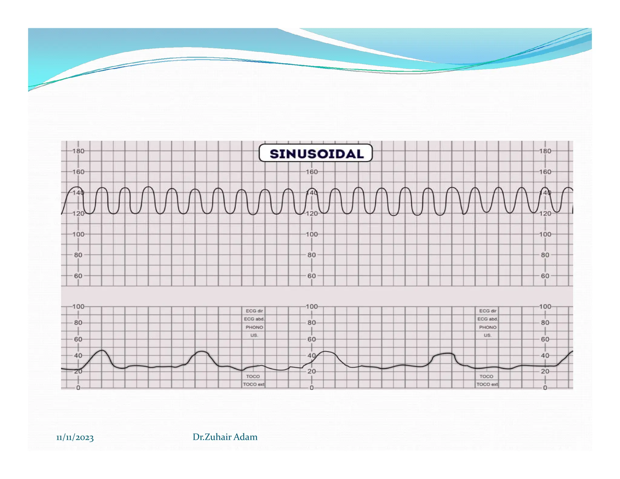 CTG INTERPRETATION Dr zuhair 2023.pdf