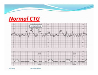 CTG INTERPRETATION Dr zuhair 2023.pdf