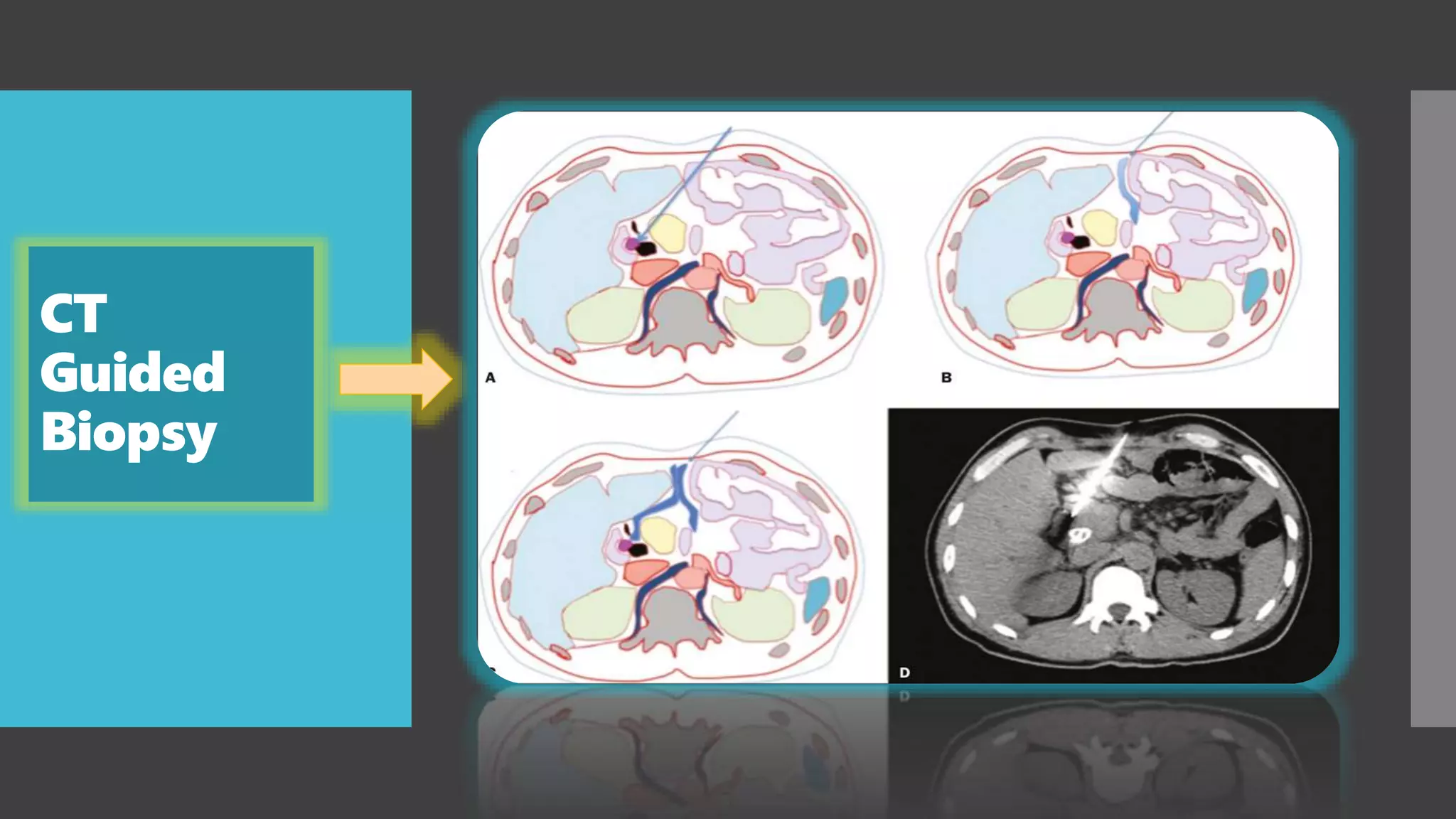 CT Guided Biopsy.pptx