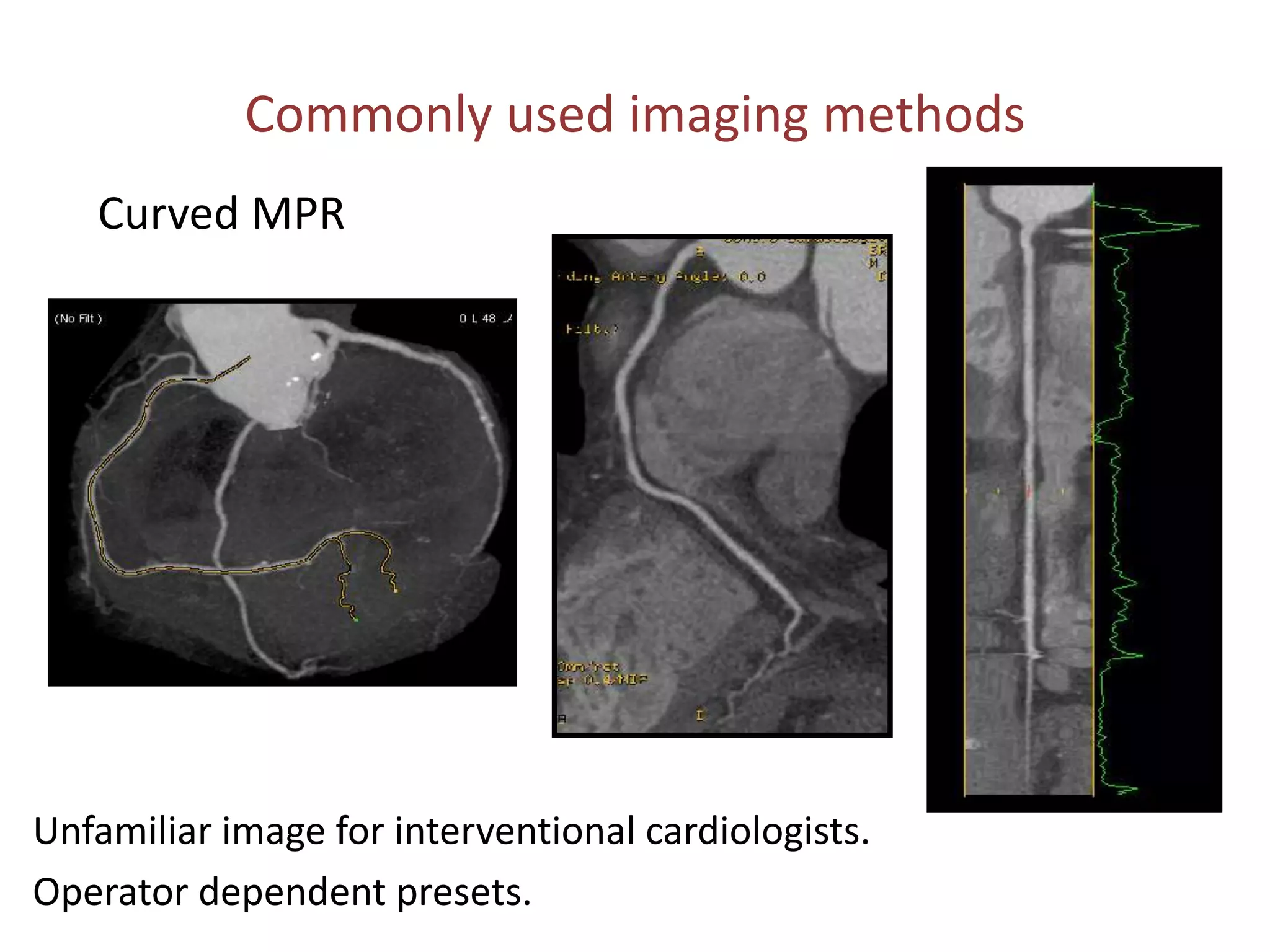 CT guided CTO PCI | PPTX
