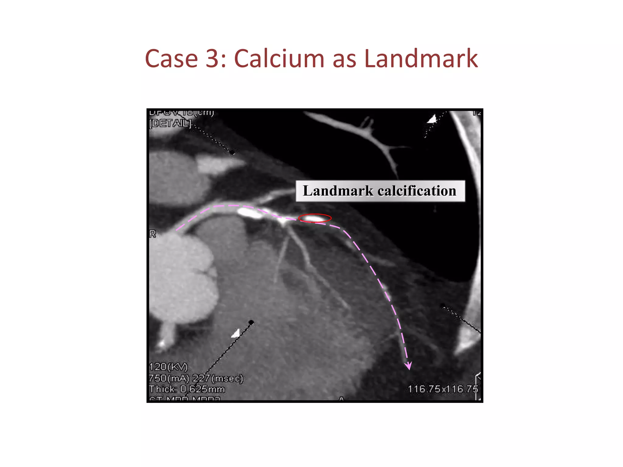 CT guided CTO PCI | PPTX