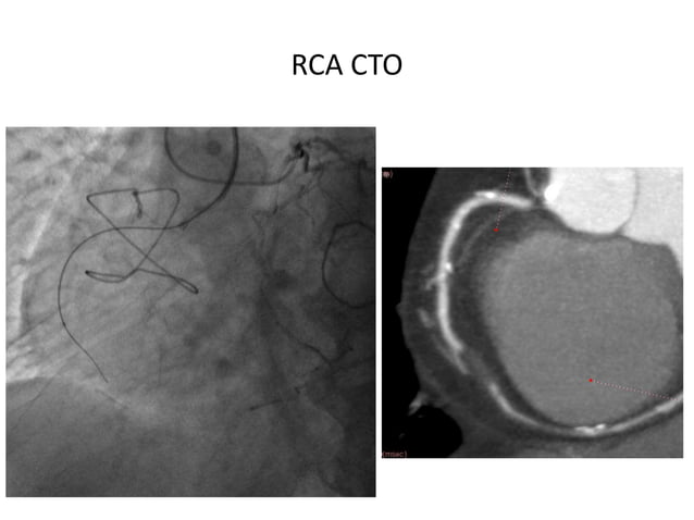 CT guided CTO PCI | PPT