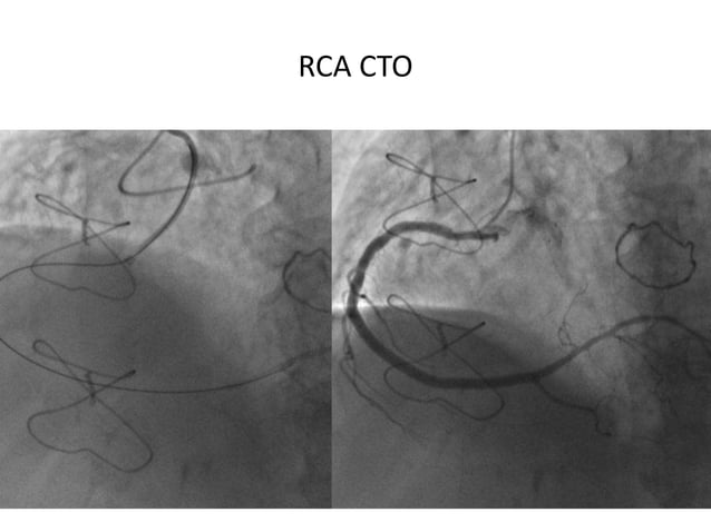 CT guided CTO PCI | PPT
