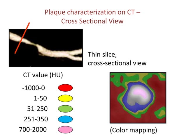 CT guided CTO PCI | PPT