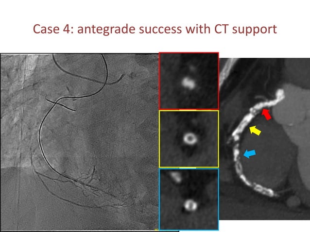 CT guided CTO PCI | PPT