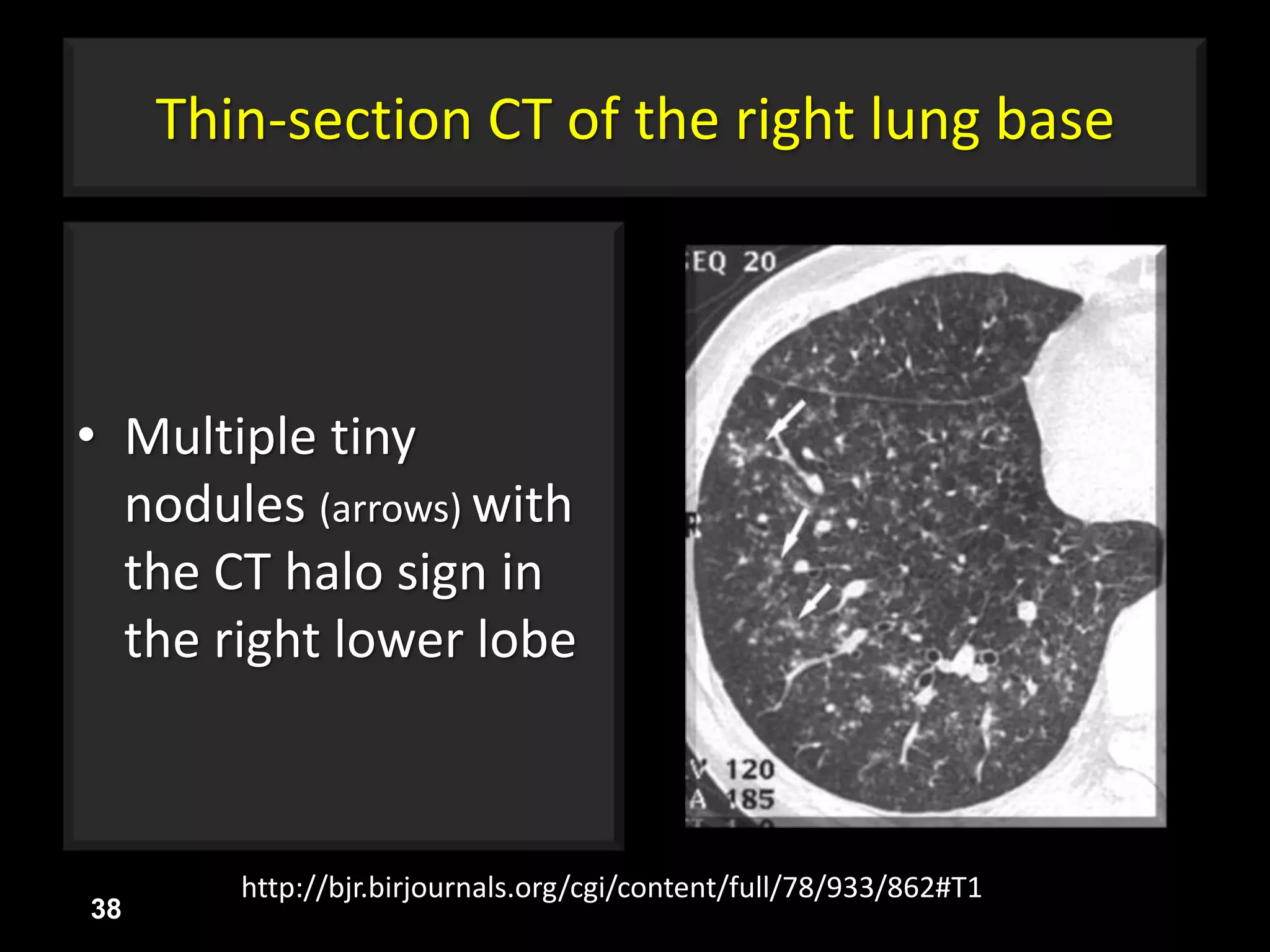 Ct halo sign (part 1) | PPTX