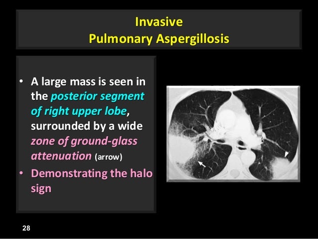 Ct halo sign (part 1)