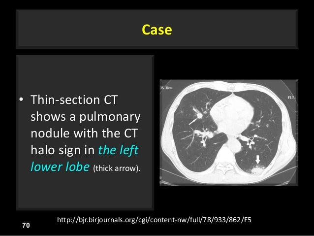 Ct halo sign (part 1)