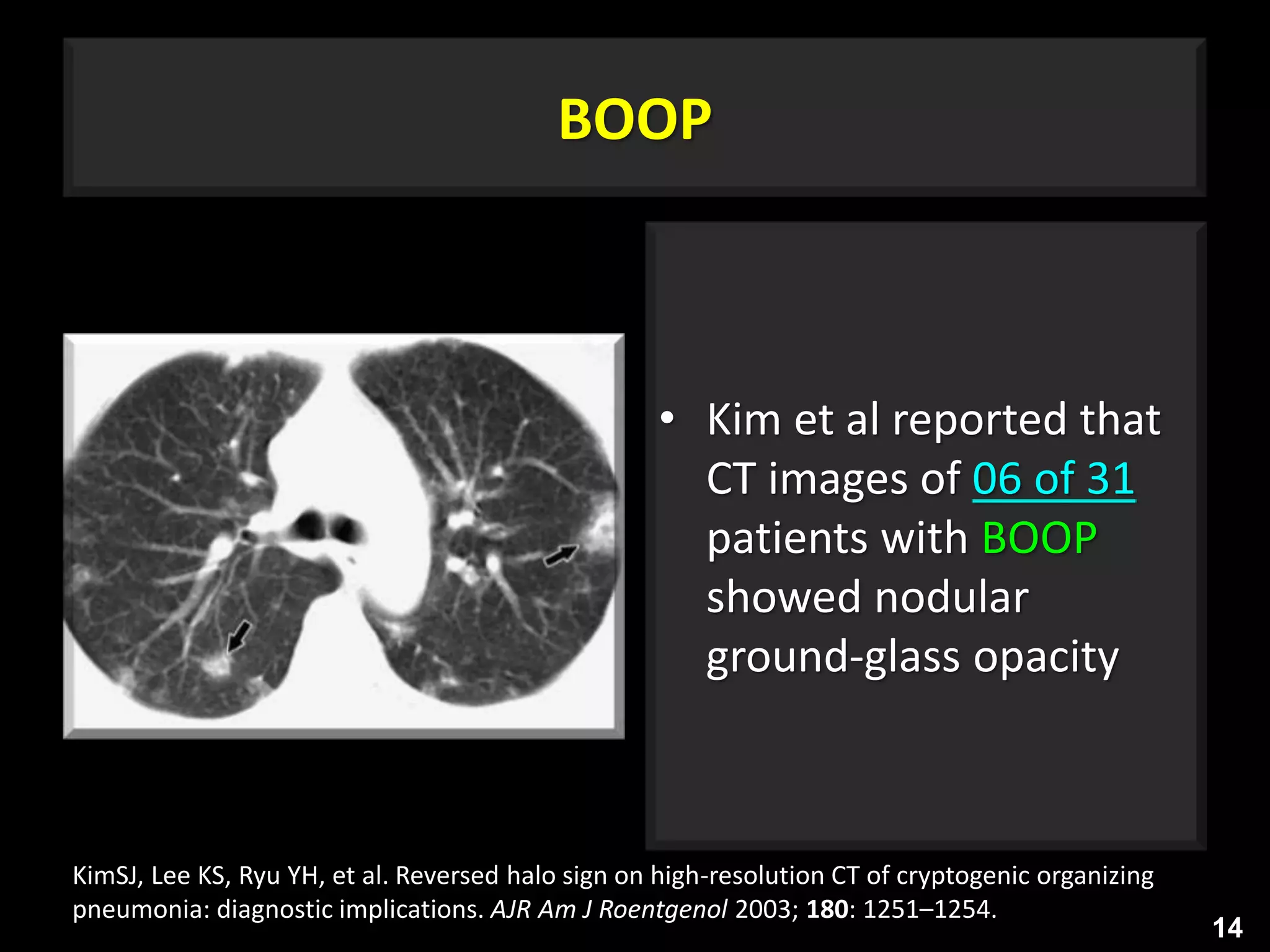 Ct halo sign (part 2) hampton hump sign-westermark sign | PPTX