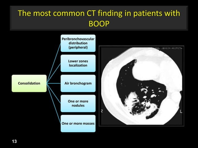 Ct halo sign (part 2) hampton hump sign-westermark sign | PPT