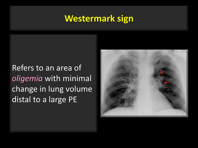 Ct halo sign (part 2) hampton hump sign-westermark sign