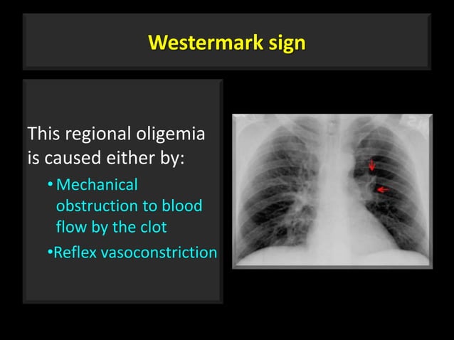 Ct halo sign (part 2) hampton hump sign-westermark sign