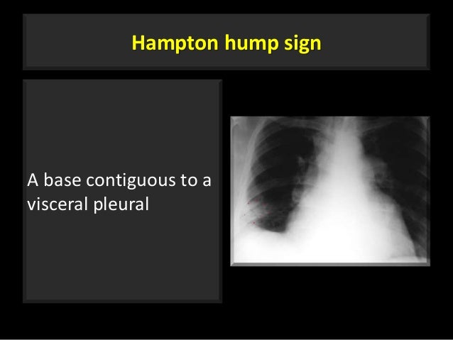 Ct halo sign (part 2) hampton hump sign-westermark sign