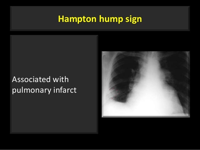 Ct halo sign (part 2) hampton hump sign-westermark sign